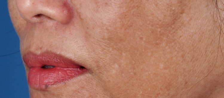 I Am Pregnant And My Skin Is Producing Dark Patches Is This Normal i-am-pregnant-and-my-skin-is-producing-dark-patches-is-this-normal