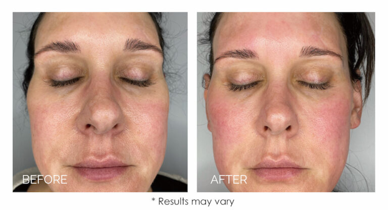 BELA MD Hydro Infusion Facial (H2) - Clarity MedSpa